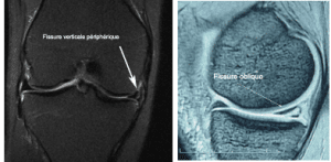 La lésion méniscale du sportif: la fissure ou la déchirure du ménisque