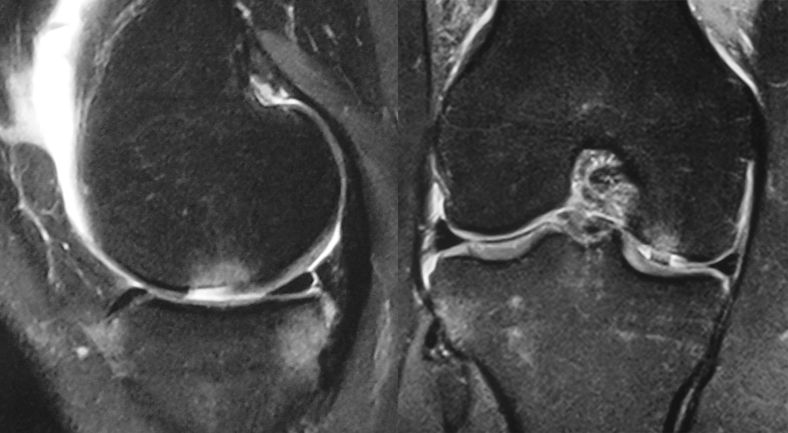 Arthroscopic debridement and perforations in the treatment of cartilage ...
