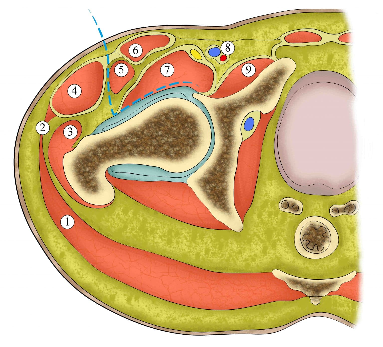 Total joint replacement hip minimally invasive anterior approach ...