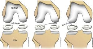 Chirurgie du ménisque, optez pour l'auto rééducation